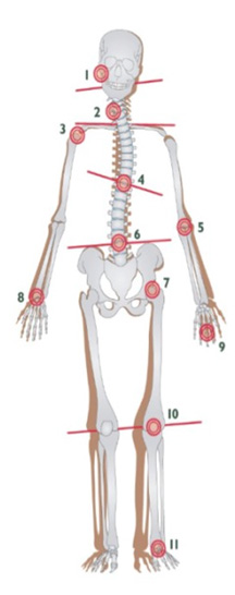 Bekkenscheefstand – malalignment syndrome - Care 2 Live